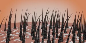 Dandruff vs Product Buildup: How to Treat Each One