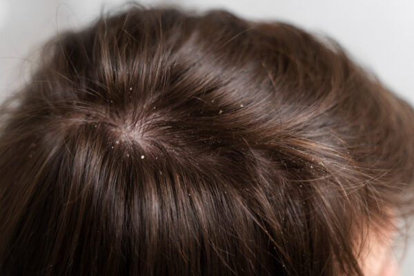 13 Common Scalp Conditions: Causes, Symptoms & Treatments