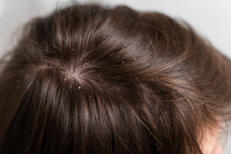 13 Common Scalp Conditions: Causes, Symptoms & Treatments