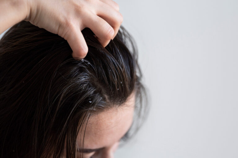 13 Common Scalp Conditions: Causes, Symptoms & Treatments